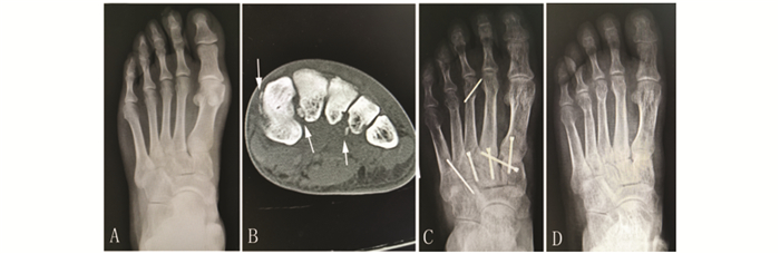 Comparison of the effect of different surgical methods on Lisfranc injury