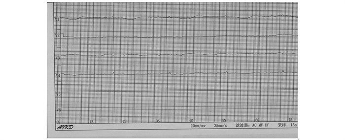 Study of electrocardial vectors synthesis of opposite sides ventricular ...