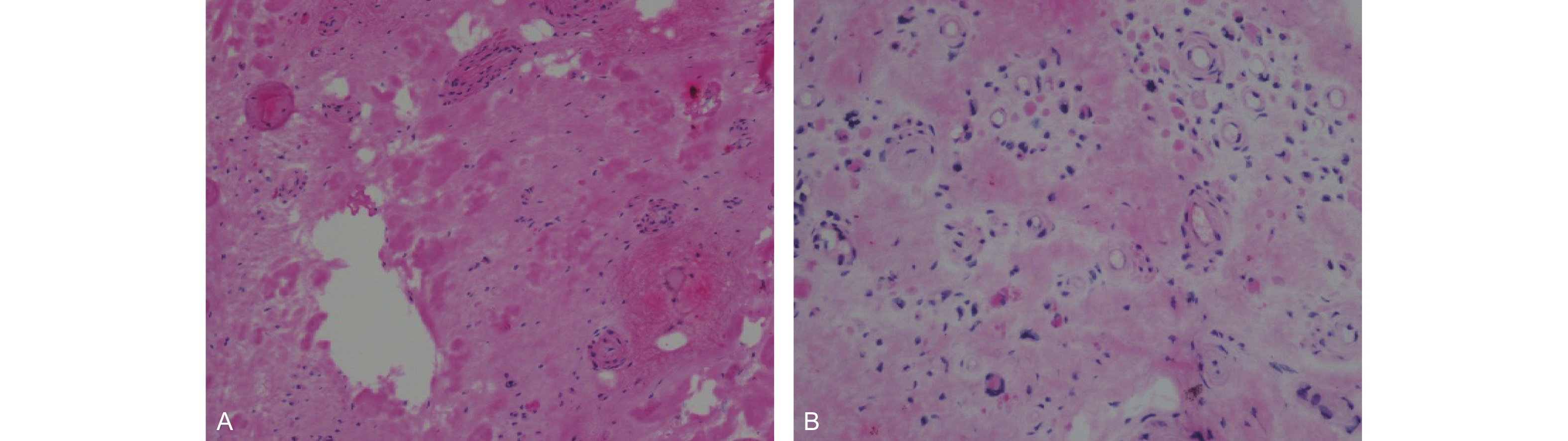 PLA2G6基因突变相关伴小脑萎缩的早发性帕金森综合征1例